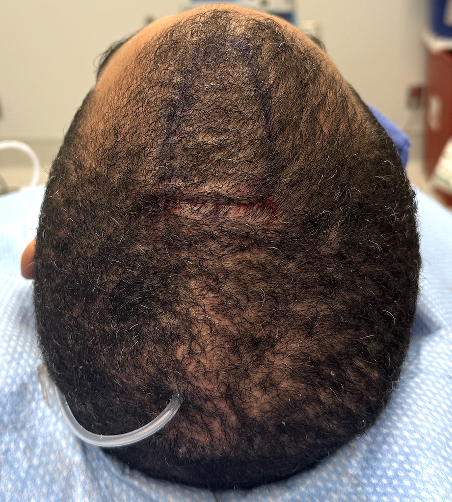 The Anterior Sagittal Crest Reduction in Humans: Case Study - Explore ...