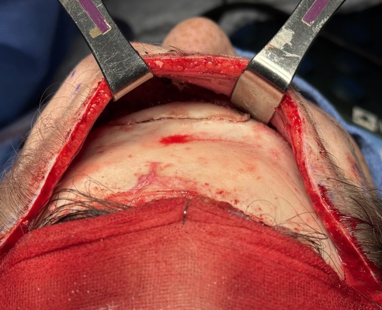 Case Study: Dual Brow Bone Reduction Techniques in Forehead ...