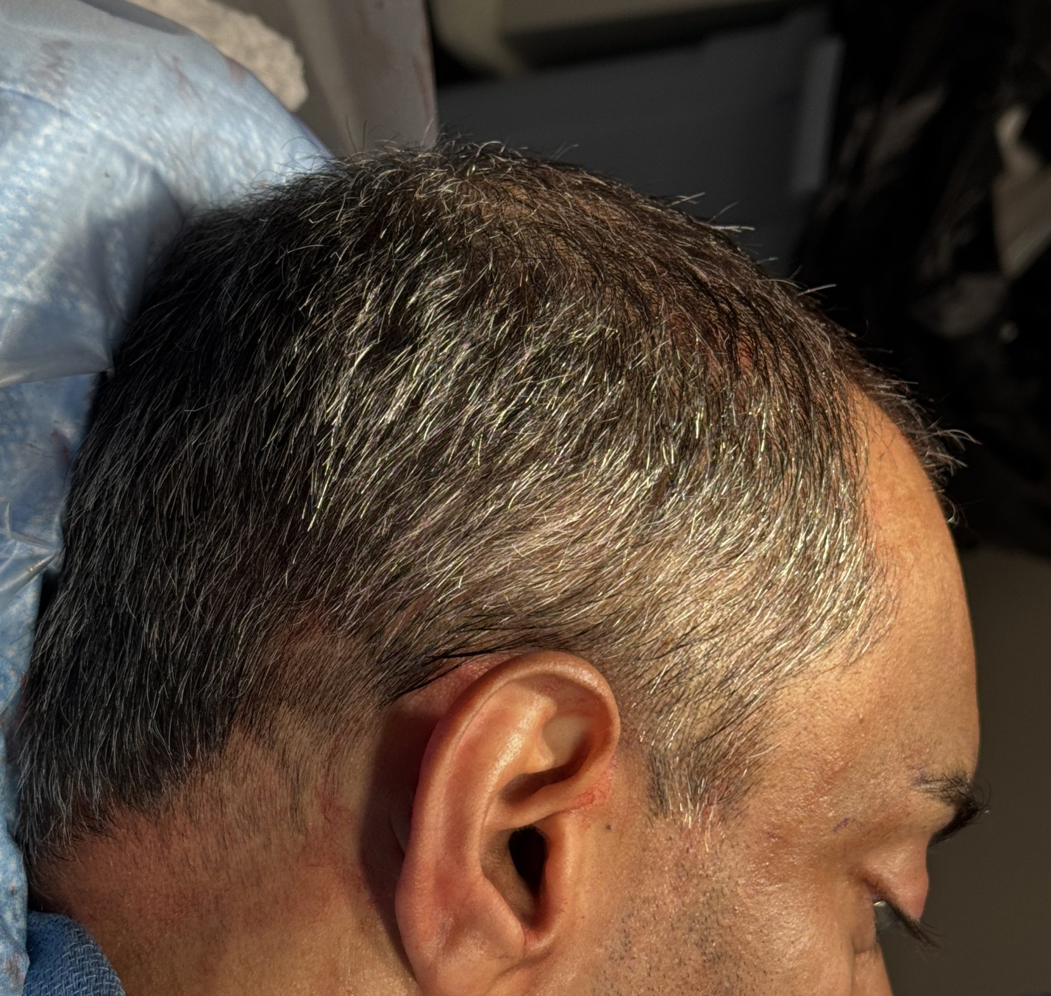 Plastic Surgery Case Study: Custom Wrap-Around Skull Implant for Narrow ...