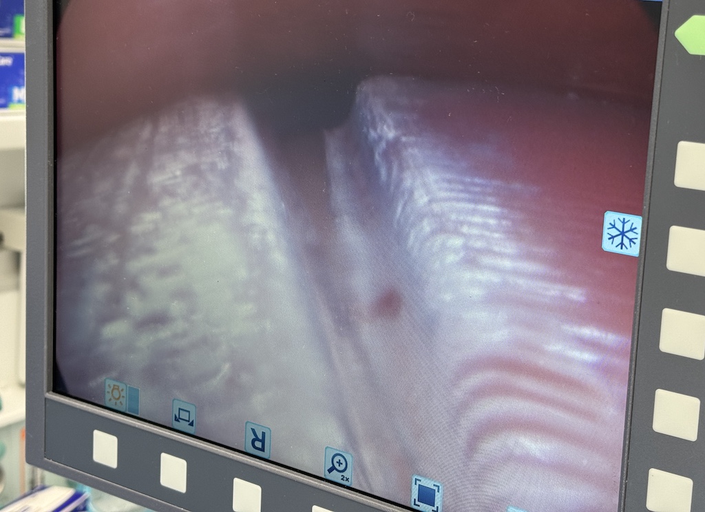 endoscopic midline forehead implant union Dr Barry Eppley - Explore ...