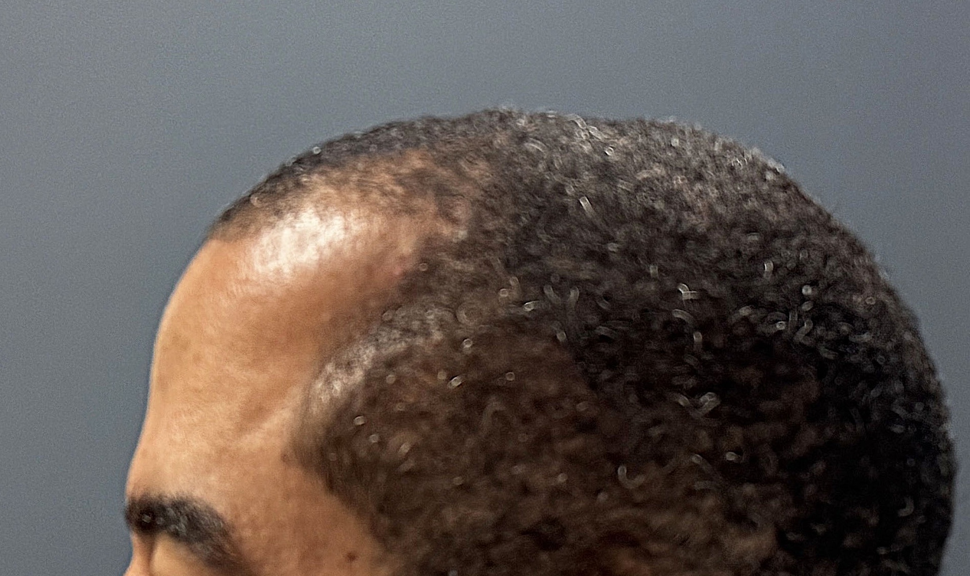 male anterior sagittal ridge skull reductionj side 2 Dr Barry Eppley ...