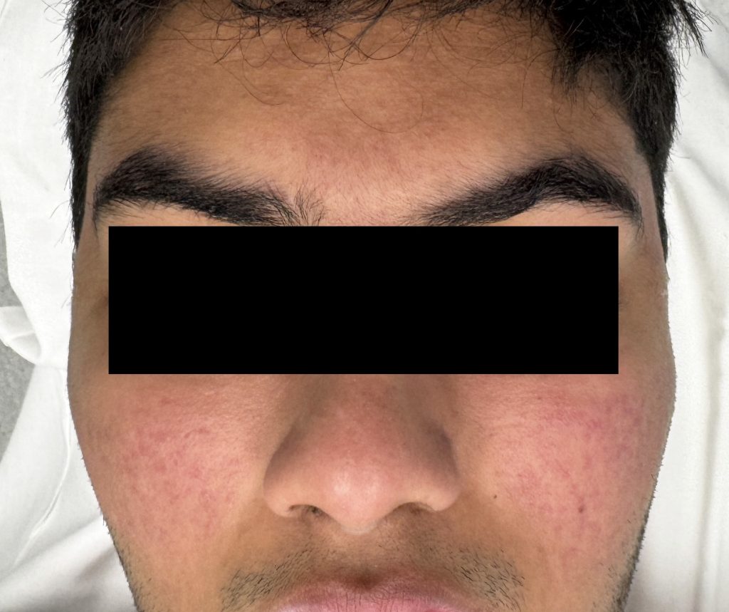 Cheekbone Reduction Case Study - Explore Plastic Surgery