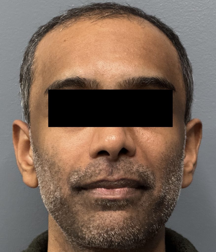 Plastic Surgery Case Study: Custom Wrap-Around Skull Implant for Narrow ...