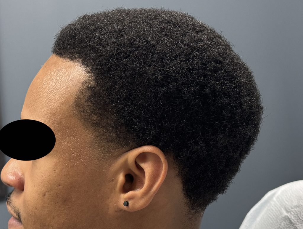 Plastic Surgery Case Study: Occipital Bone Reduction Surgery for ...