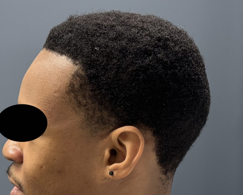 Plastic Surgery Case Study: Occipital Bone Reduction Surgery for ...