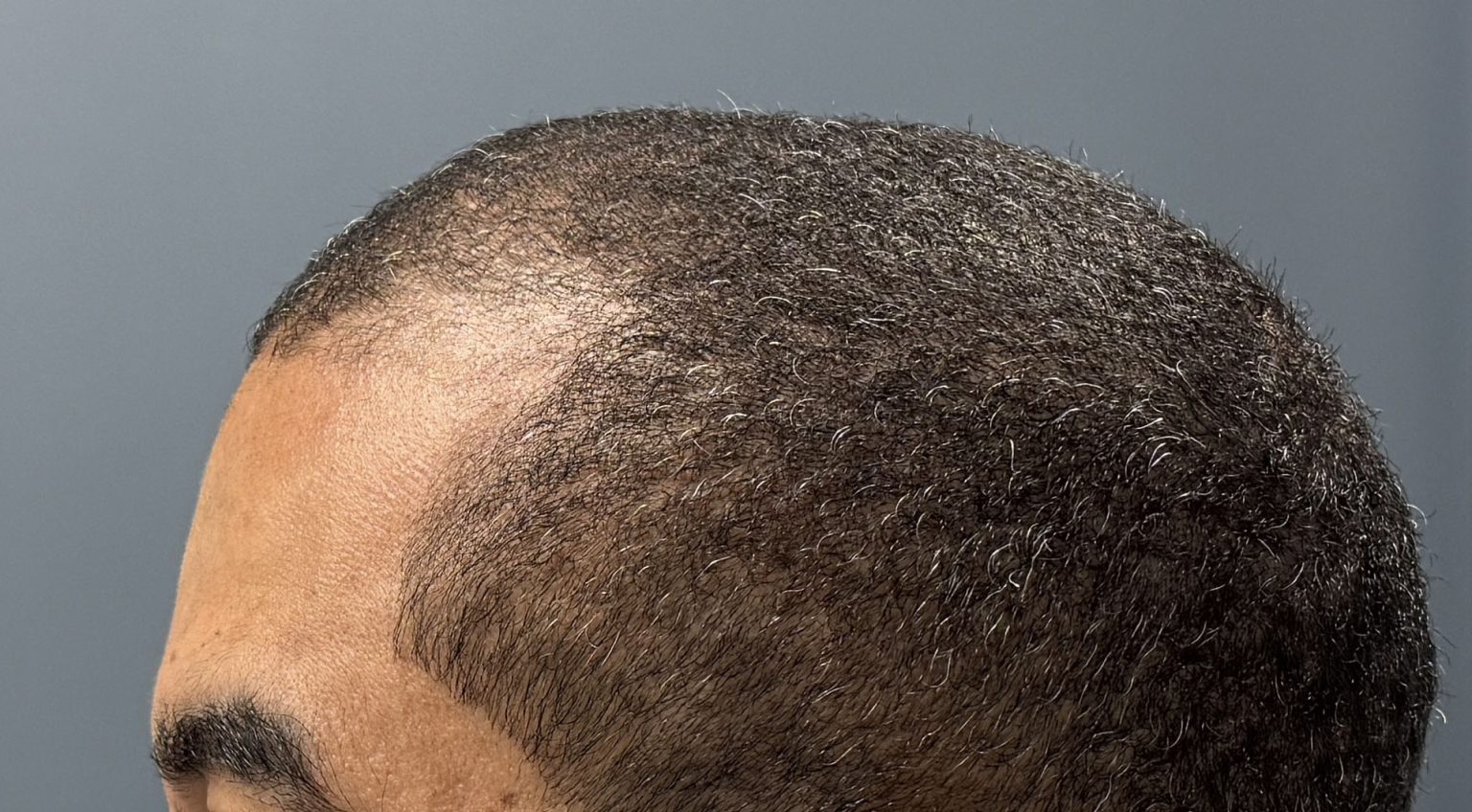 The Anterior Sagittal Crest Reduction in Humans: Case Study - Explore ...