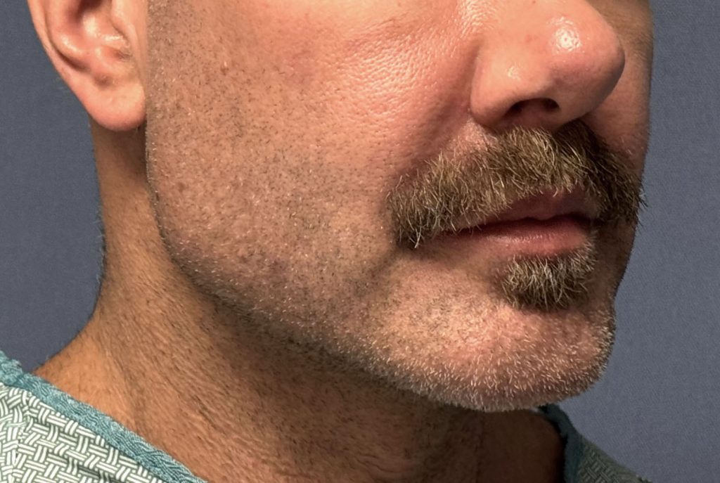 Case Study: Custom Jawline Implant with Jaw Angle Muscle Augmentation ...