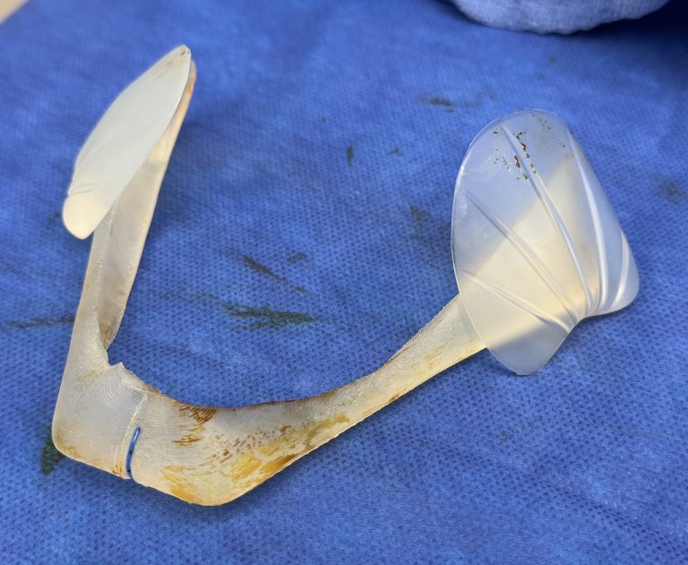 Case Study: Custom Jawline Implant with Jaw Angle Muscle Augmentation ...