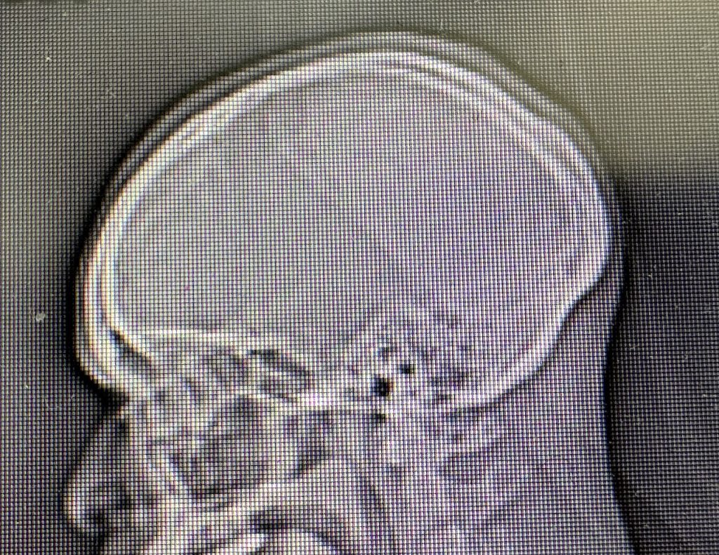 Plastic Surgery Case Study: Occipital Bone Reduction Surgery for ...