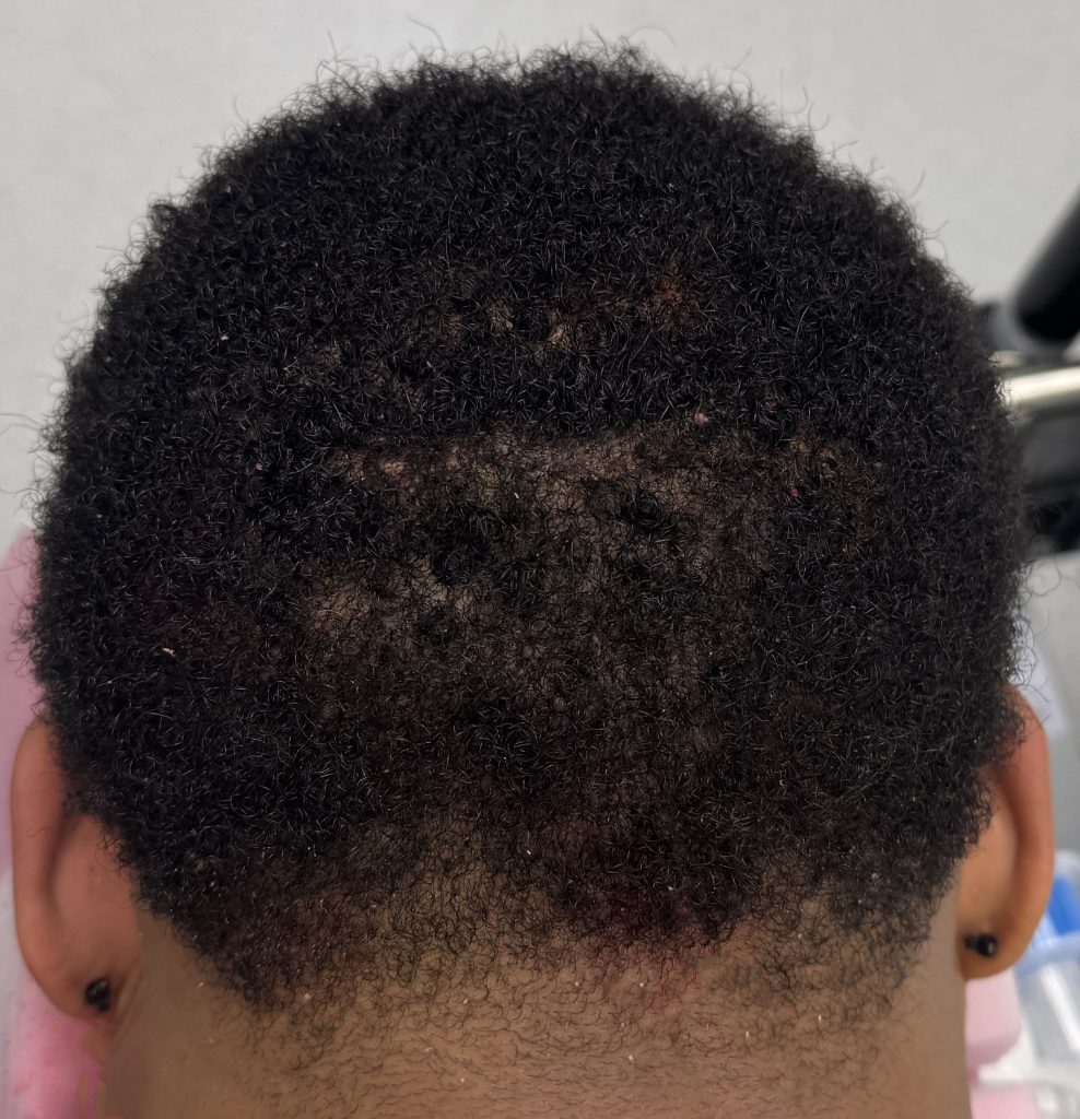 Plastic Surgery Case Study: Occipital Bone Reduction Surgery for ...