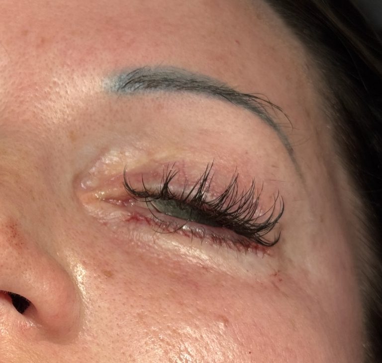 Case Study: Pinch and Peel Lower Blepharoplasty - Explore Plastic Surgery