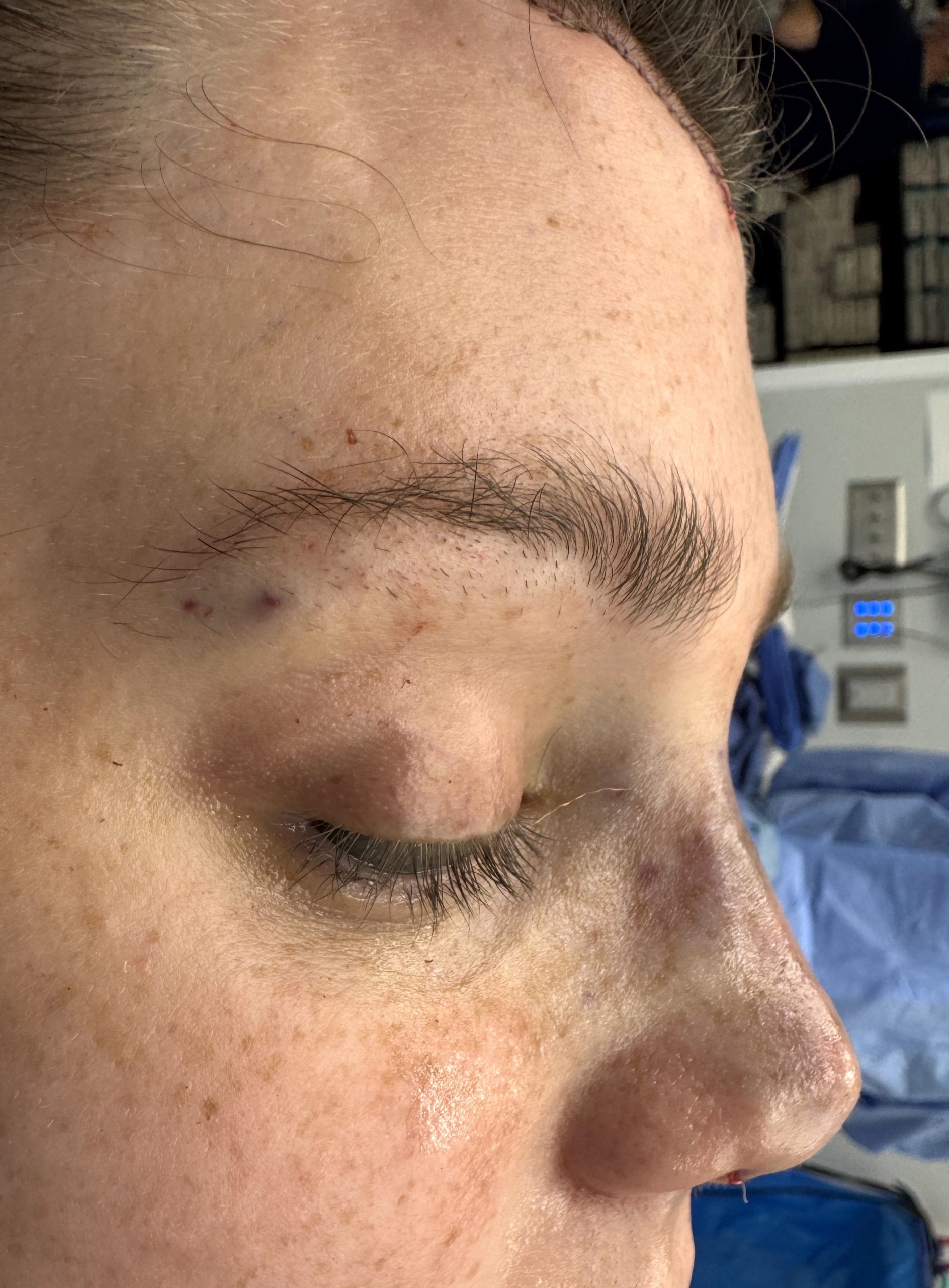 transfemale brow bone reduction intraop side view Dr Barry Eppely ...