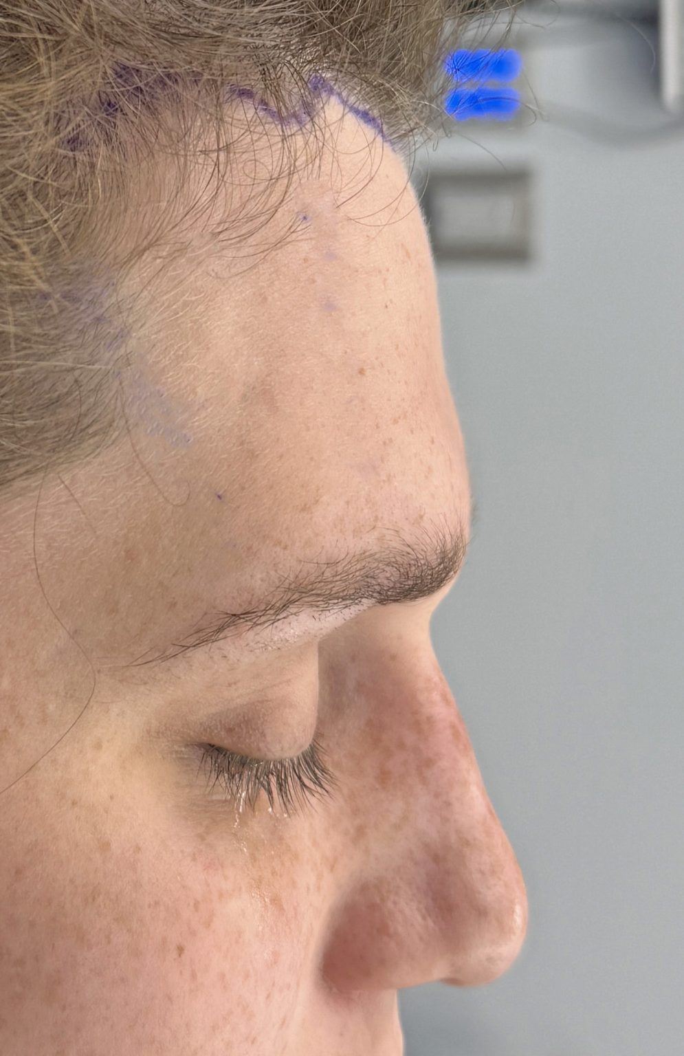 Case Study: Dual Brow Bone Reduction Techniques in Forehead ...