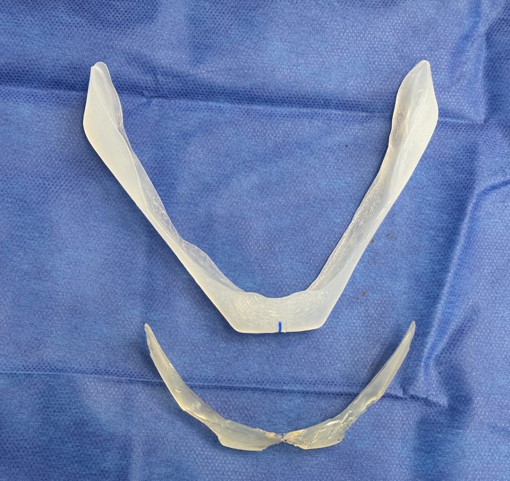 Standard vs Custom Facial Masculinization Implants Case Study - Explore ...