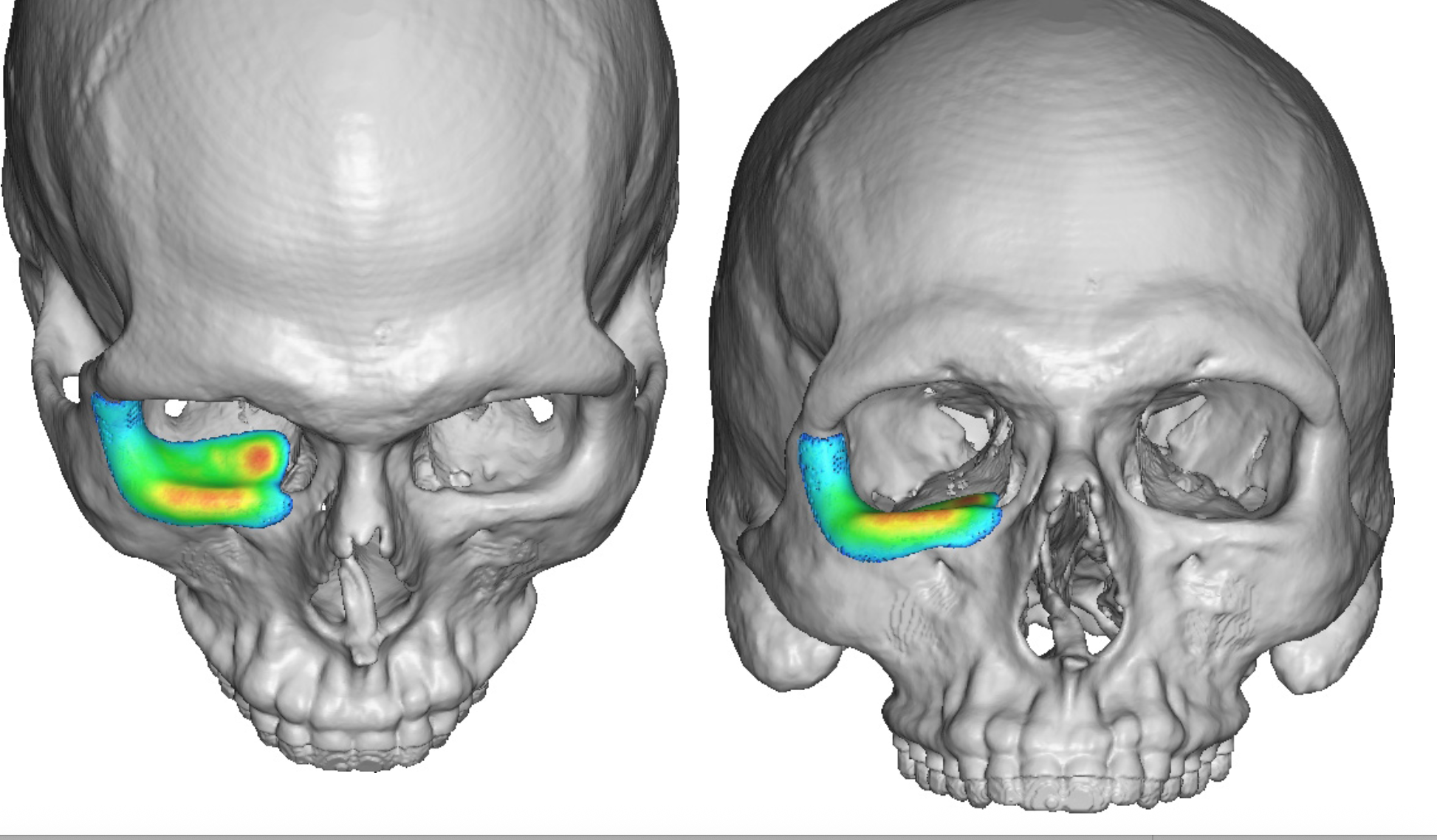 Custom Vertical Orbital Dystopia Implant - Explore Plastic Surgery
