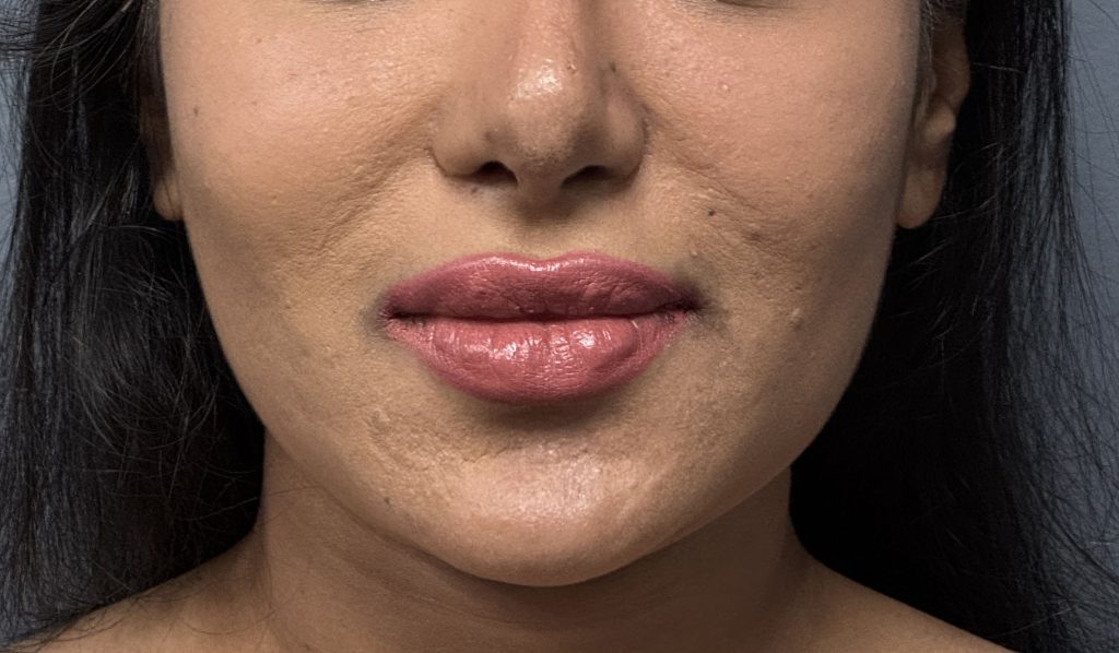 Case Study - Secondary Vertical Lengthening Bony Genioplasty After A ...
