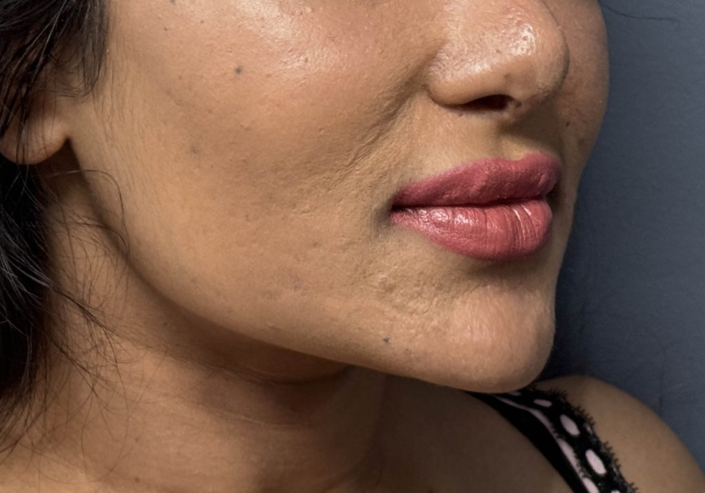 Case Study - Secondary Vertical Lengthening Bony Genioplasty After A ...