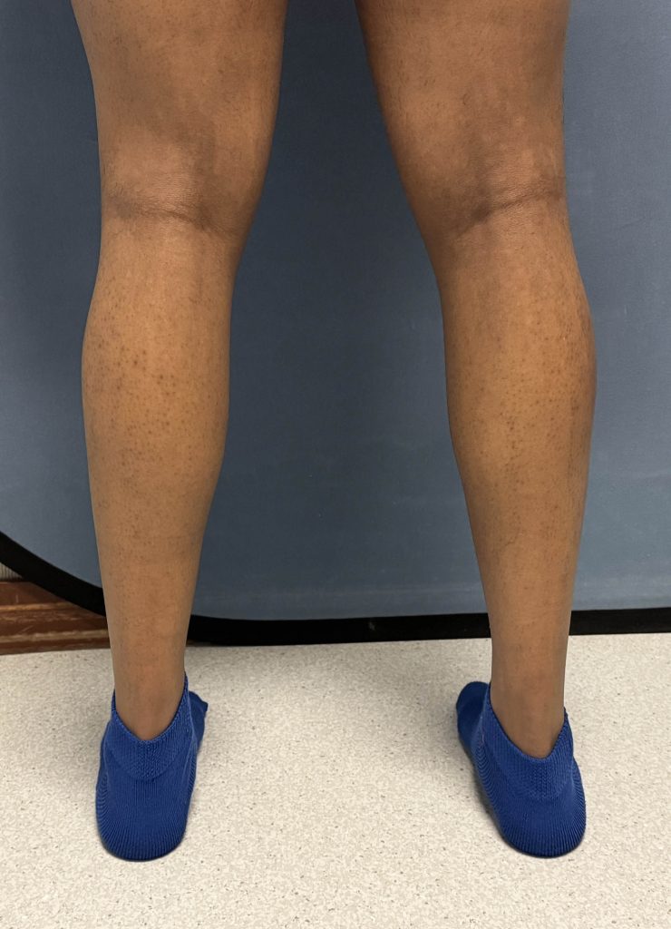 male calf implants back 1 Dr Barry Eppley - Explore Plastic Surgery