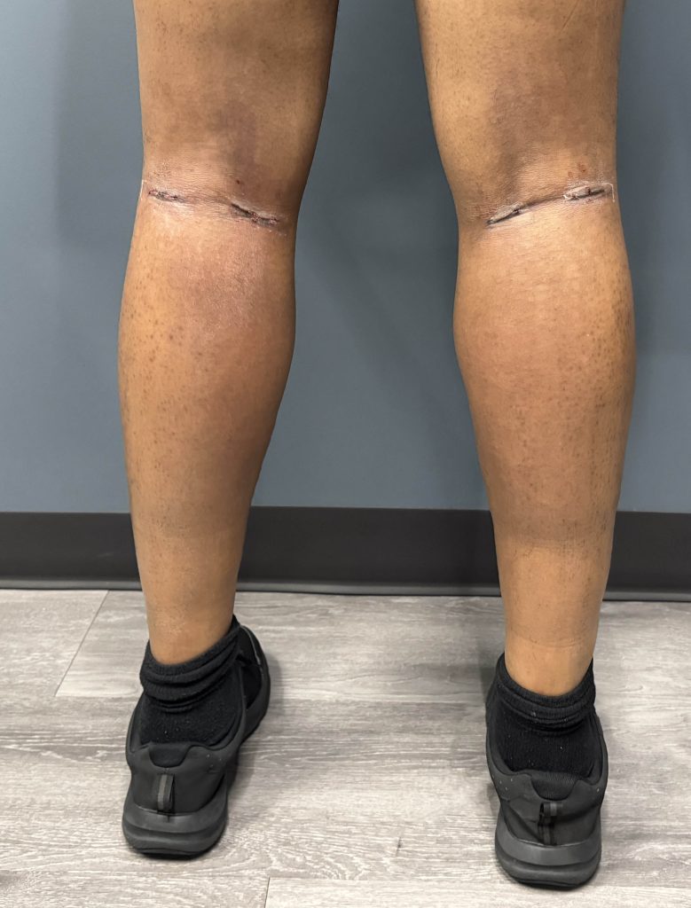 male calf implants back 2 Dr Barry Eppley - Explore Plastic Surgery