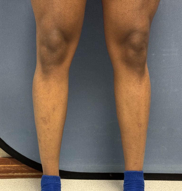 male calf implants front 1 Dr Barry Eppleyt - Explore Plastic Surgery