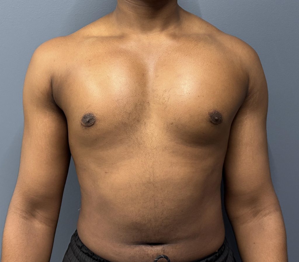 Case Study: Pectoral Implants for Improved Chest Shape and Definition ...