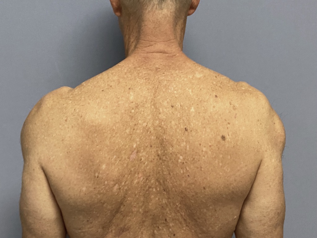 male trap implants back 1 Dr Barry Eppley - Explore Plastic Surgery