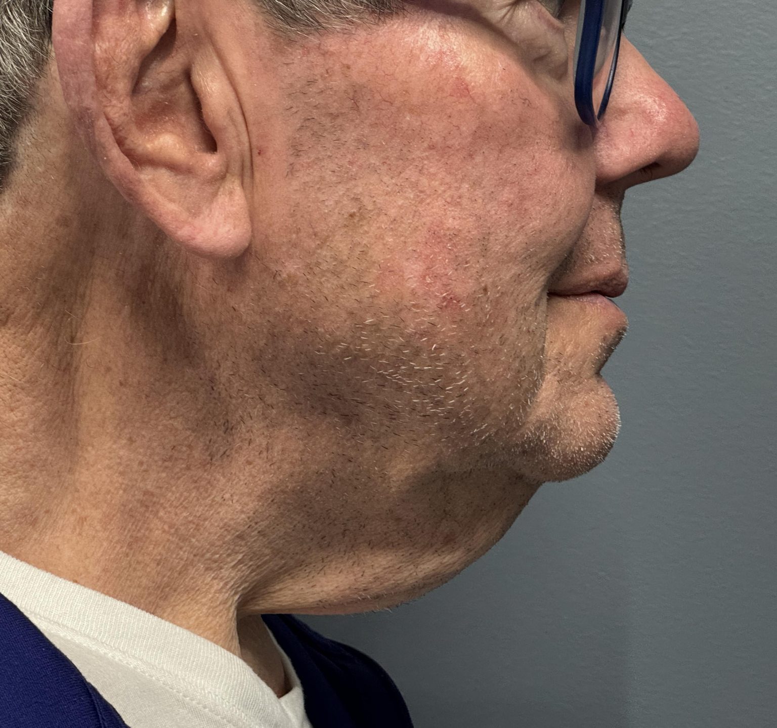 The I Pattern Direct Necklift Excision for Large Neck Wattles Case ...