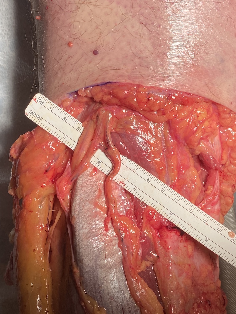 peroneal and suralk nerve dissections Dr Barry Eppley - Explore Plastic Surgery