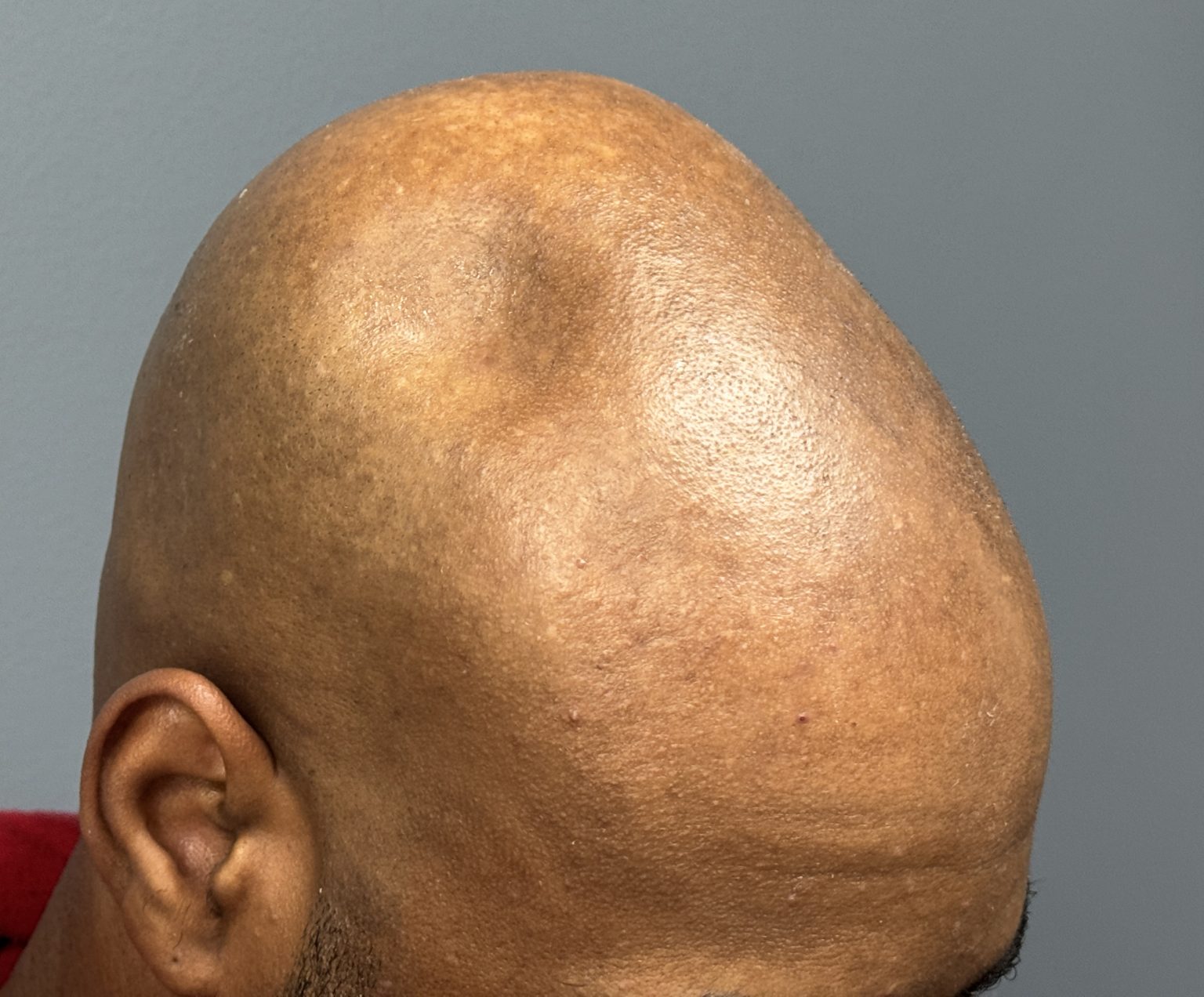 Custom Skull Dent Implant Case Study - Explore Plastic Surgery
