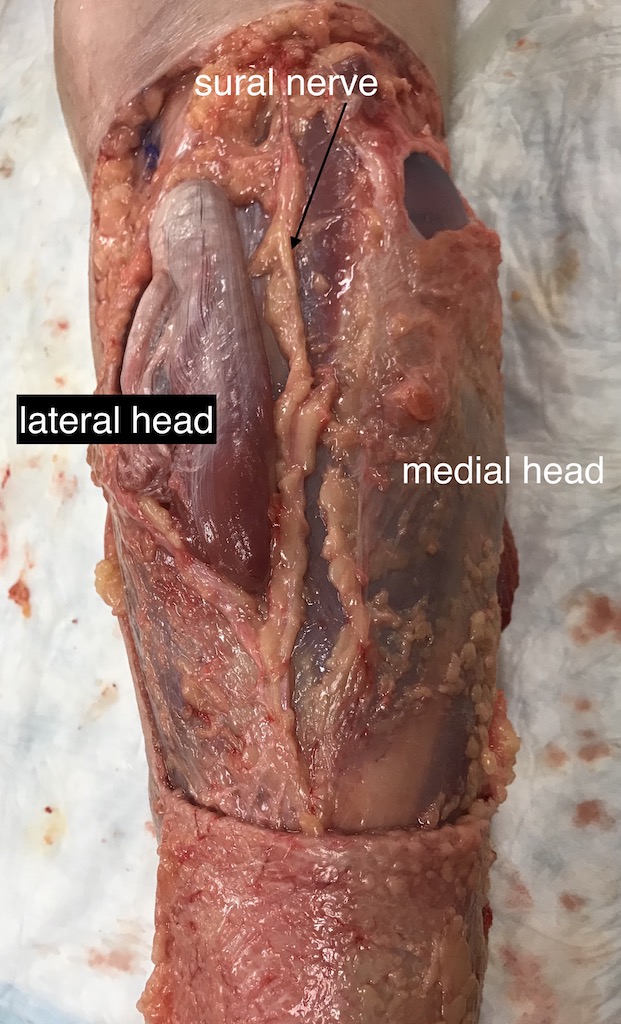 sural nerve anatomy in calf implants - Explore Plastic Surgery