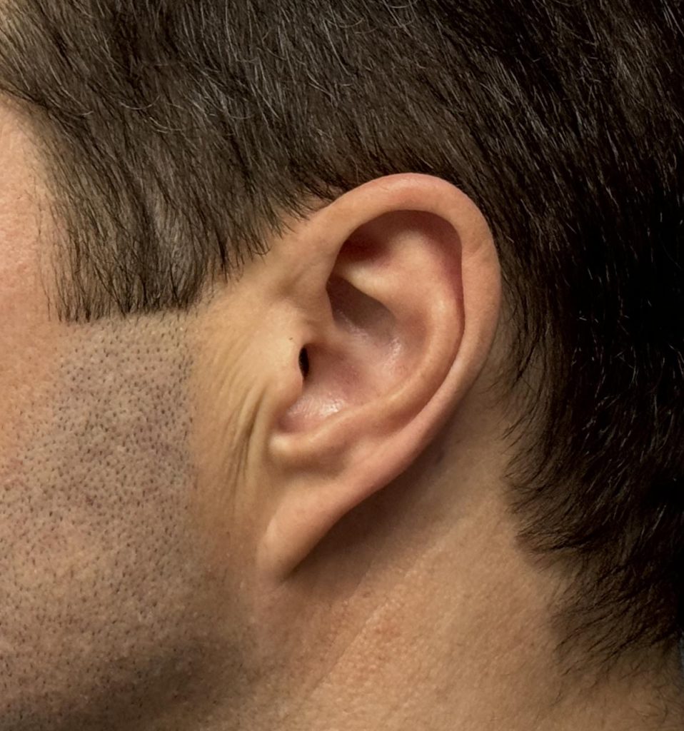 Congenitally Long Earlobe Shortening with Facelift Case Study - Explore ...