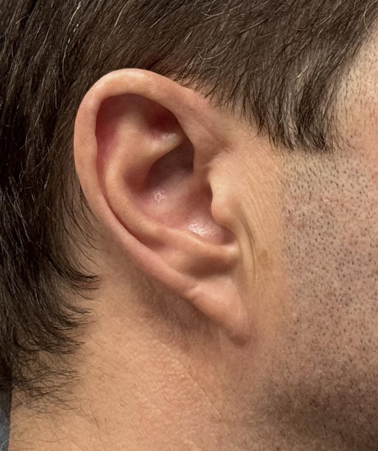 Congenitally Long Earlobe Shortening with Facelift Case Study - Explore ...