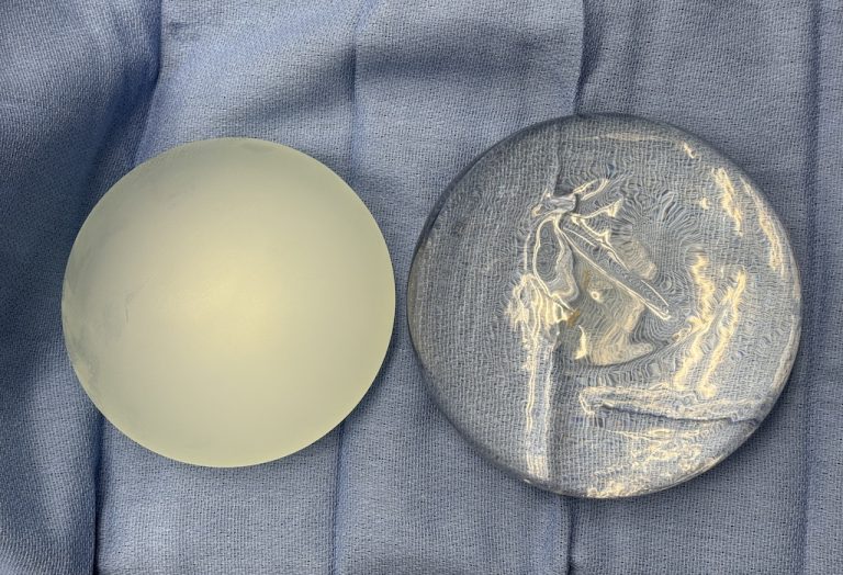 XL Silicone Breast Implants: Case Study - Explore Plastic Surgery