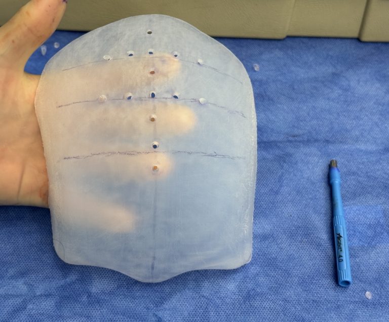 Technical Strategies - Custom Forehead Implant Placement Guides ...