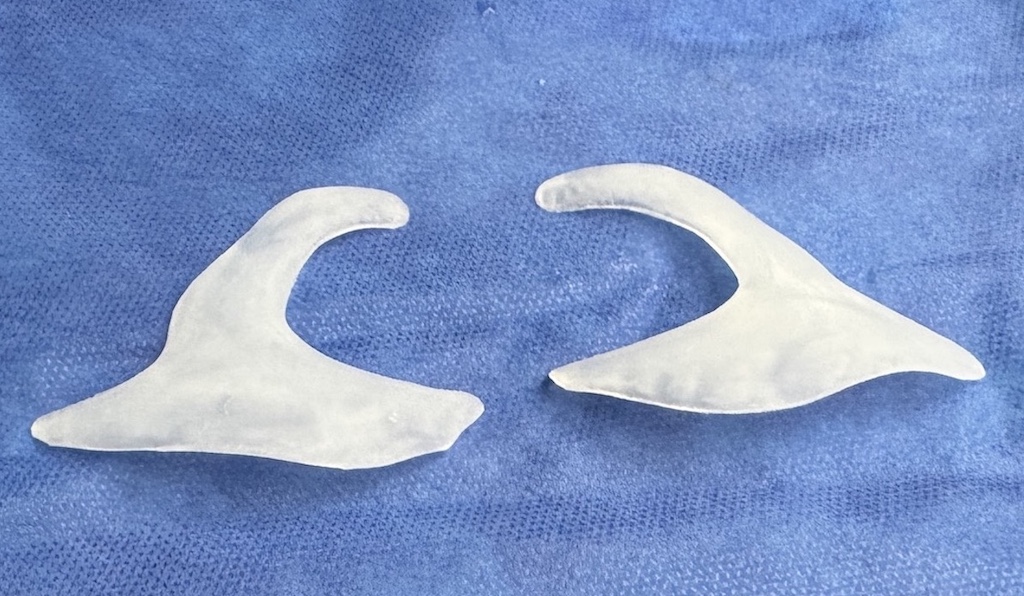 Custom Facial Implant Modification - Customizing the Custom Implant ...