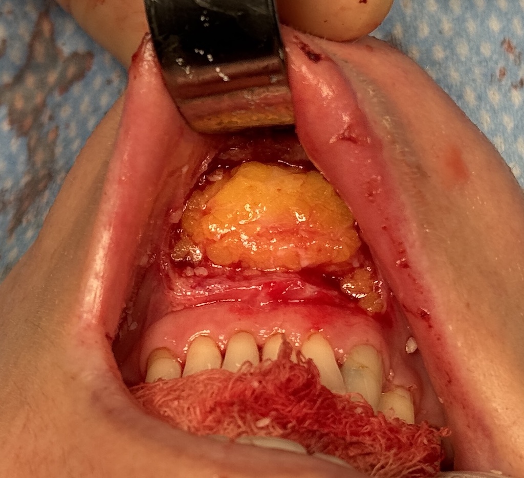 fat graft to chin Dr Barry Eppley - Explore Plastic Surgery