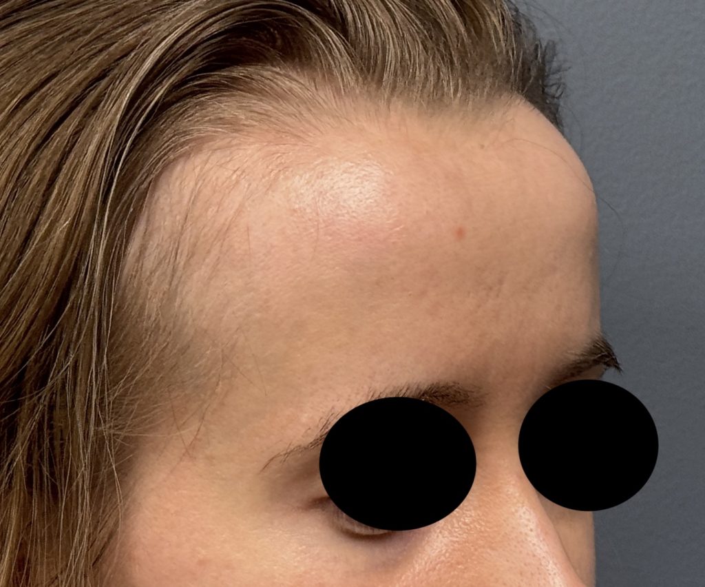 Female Frontal-Temporal Bossing Reduction – Case Study - Explore ...