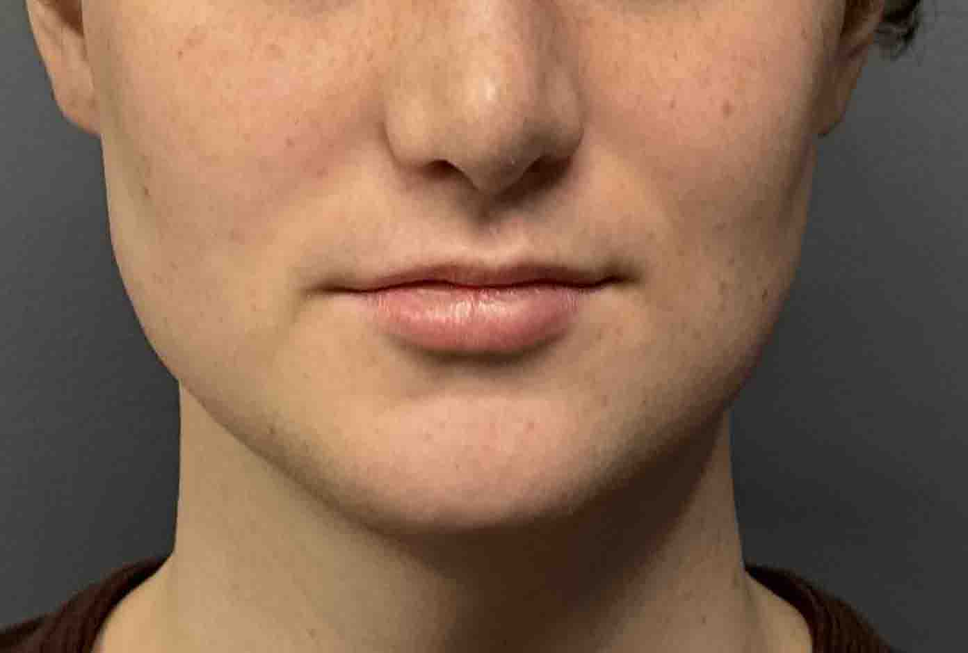 Jaw Reduction Case Study - Explore Plastic Surgery