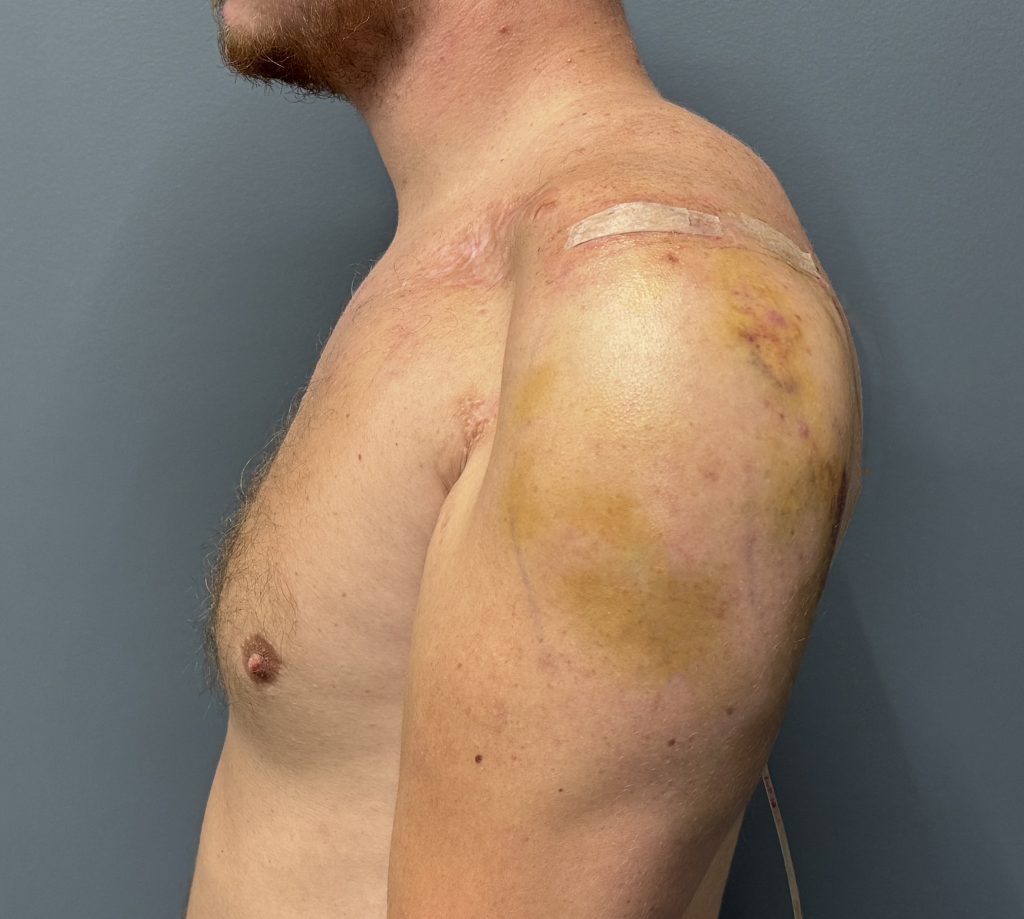 Deltoid Muscle Atrophy and Shoulder Restoration Using Custom Implants ...
