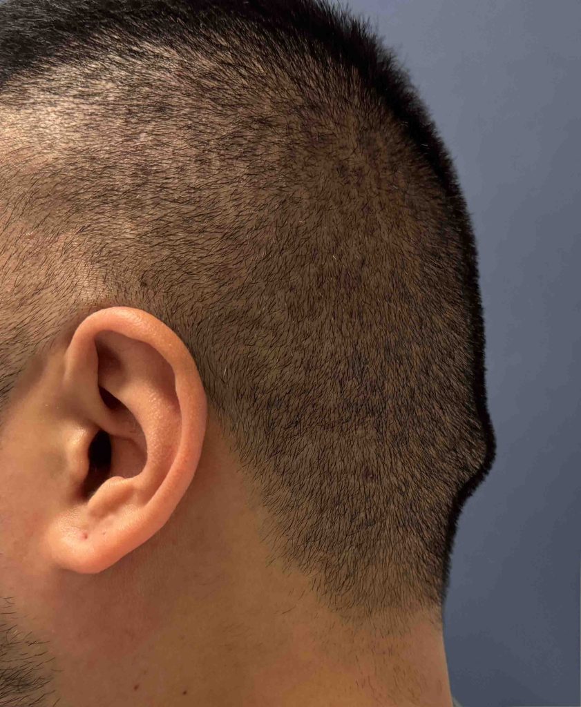 Occipital Knob and Scalp Roll Excision Case Study - Explore Plastic Surgery