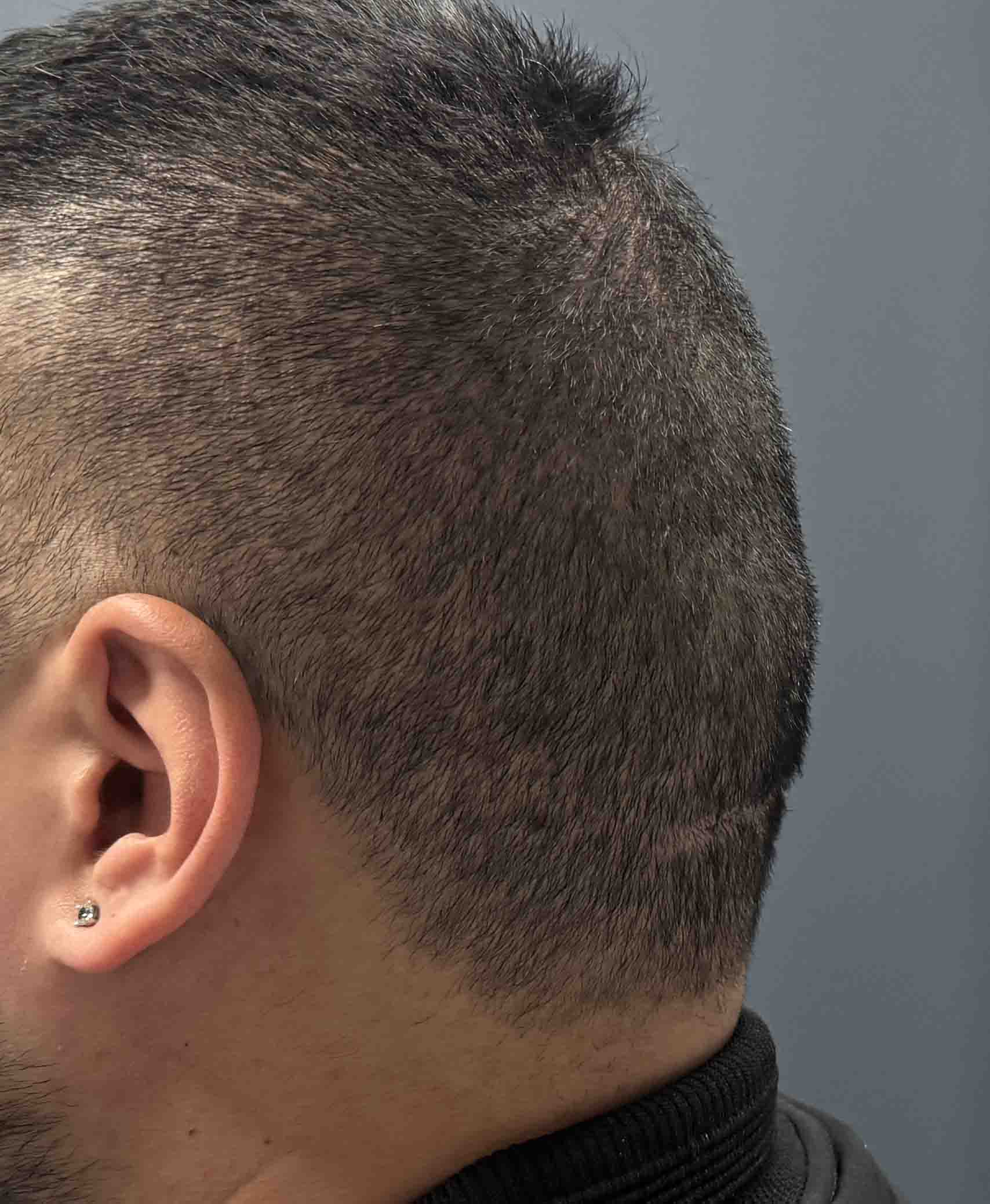 Occipital Knob and Scalp Roll Excision Case Study - Explore Plastic Surgery