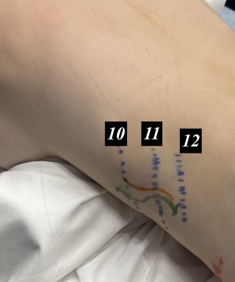 Rib Removal with Anterior Rib #10 Prominence Reductions Case Study ...