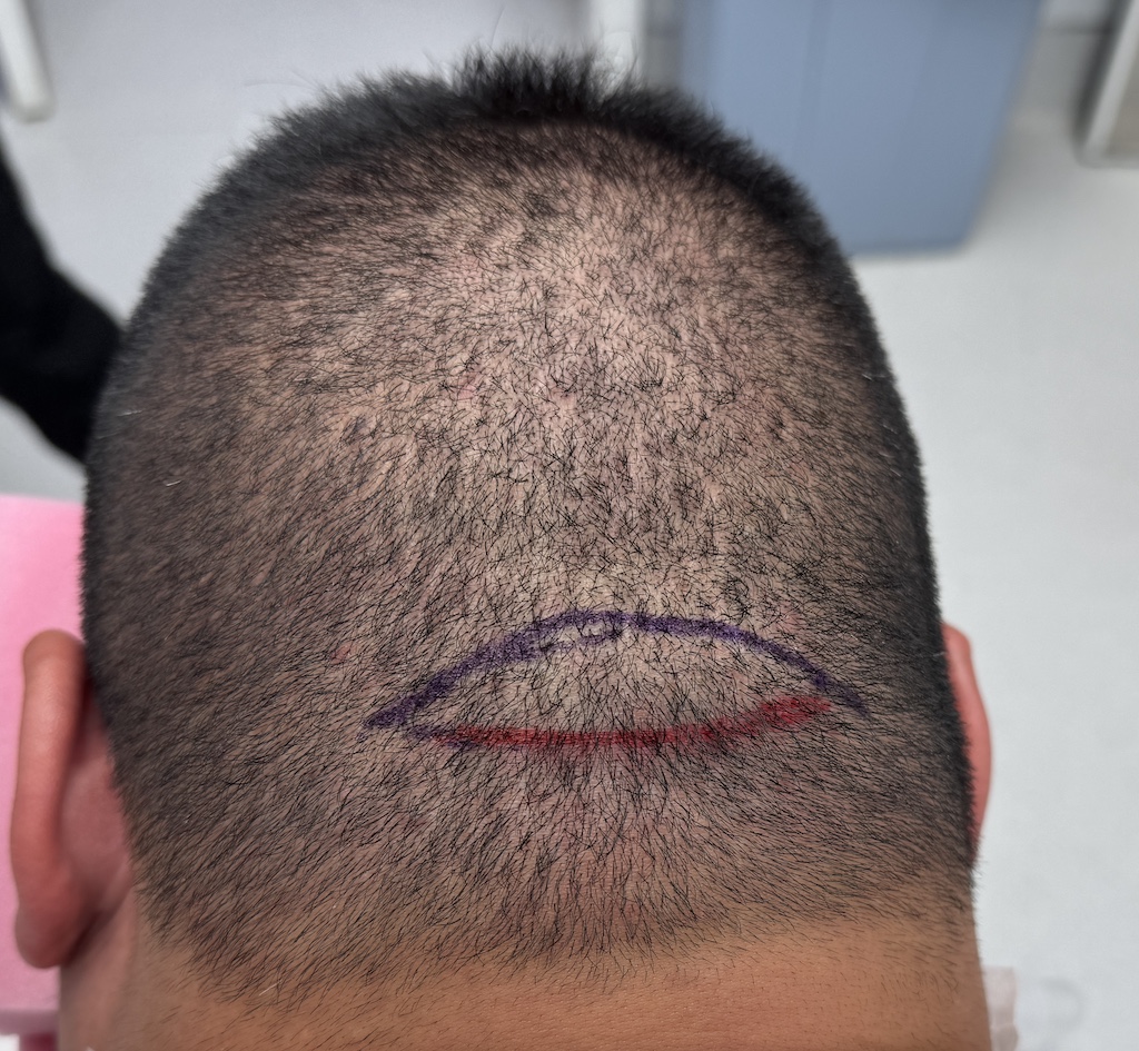 Occipital Knob and Scalp Roll Excision Case Study - Explore Plastic Surgery