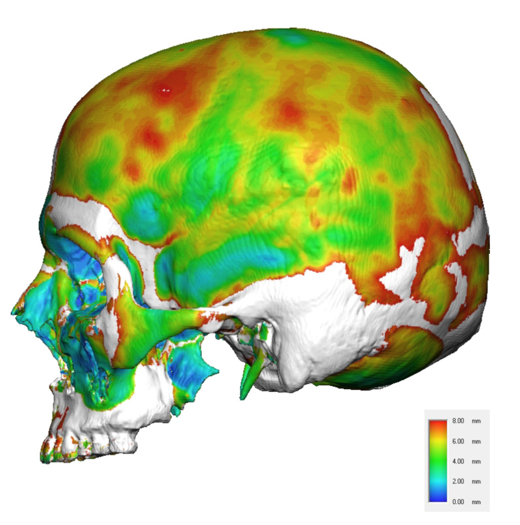 skull reshaping Archives - Explore Plastic Surgery
