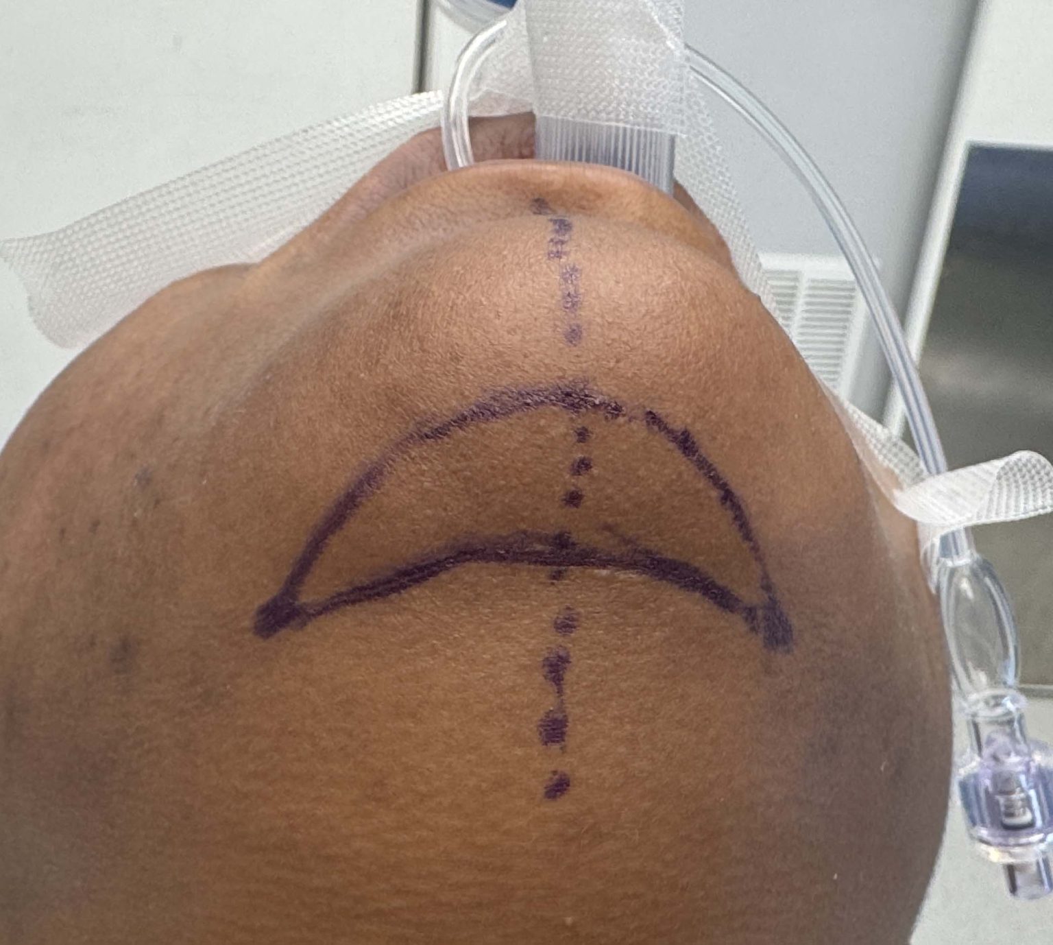 Submental Chin Pad Excision Technique - Explore Plastic Surgery