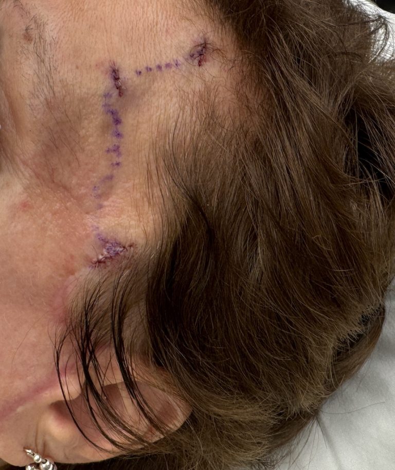 Prominent Temporal Artery Ligations Following Facelift Surgery Case ...