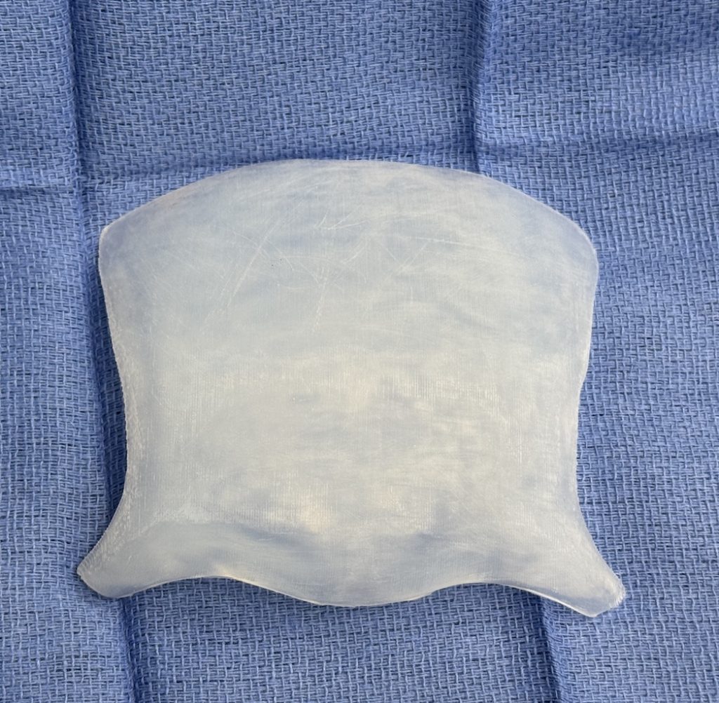 Male Custom Forehead Implant Case Study - Explore Plastic Surgery