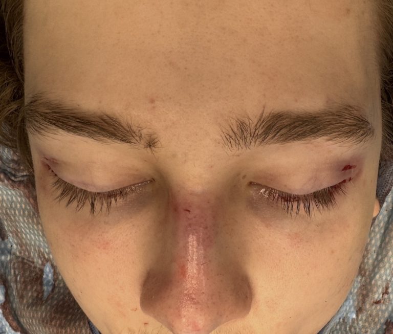 The Custom Orbital Frame Implant Case Study - Explore Plastic Surgery