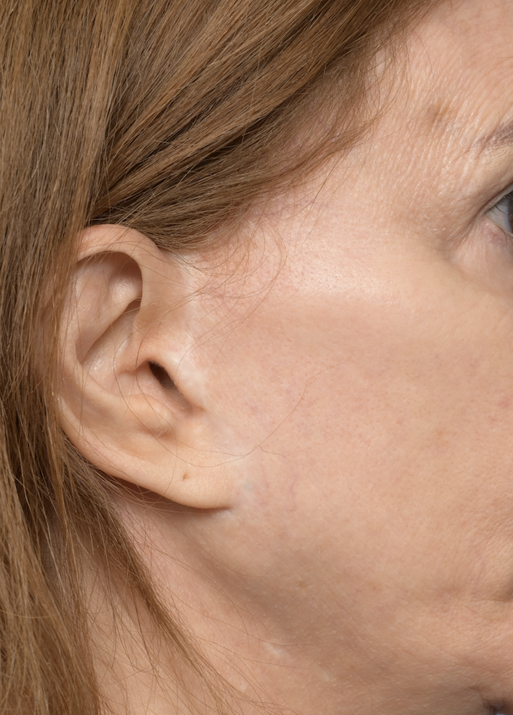 Transcutaneous Facelift Scar Placement of Jaw Angle Implants Case Study ...