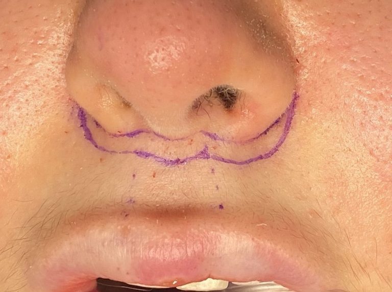 Male Surgical Lip Lifts and Advancements Case Study - Explore Plastic ...